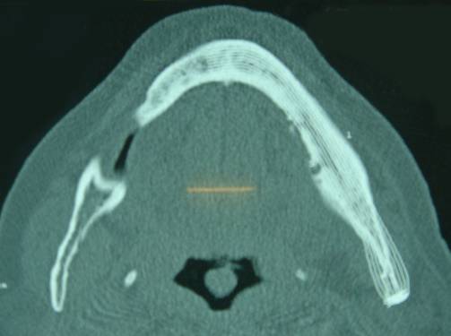osteonecrosi-della-mandibola - Prof. Luigi Clauser