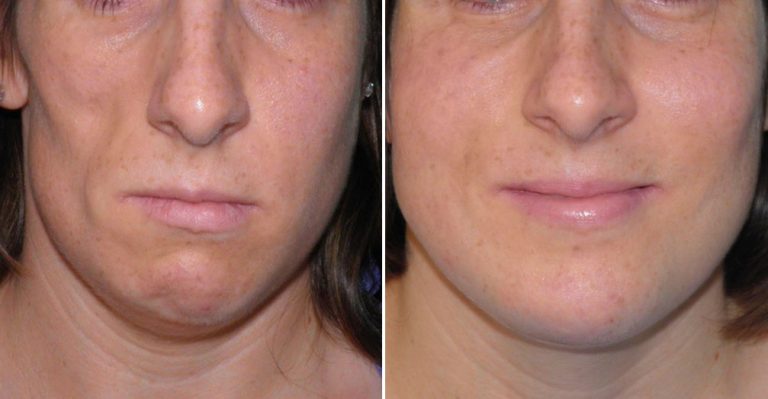 Malformazioni congenite. La chirurgia cranio-facciale. - Prof. Luigi ...